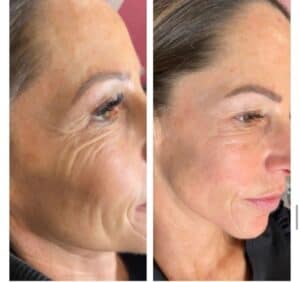 Skinbooster – Benefícios, Preços e Antes e Depois【2025】